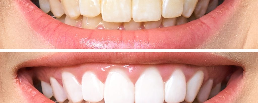 Tooth Bleaching Normal IL | 309-663-9421 Beautiful Smile!